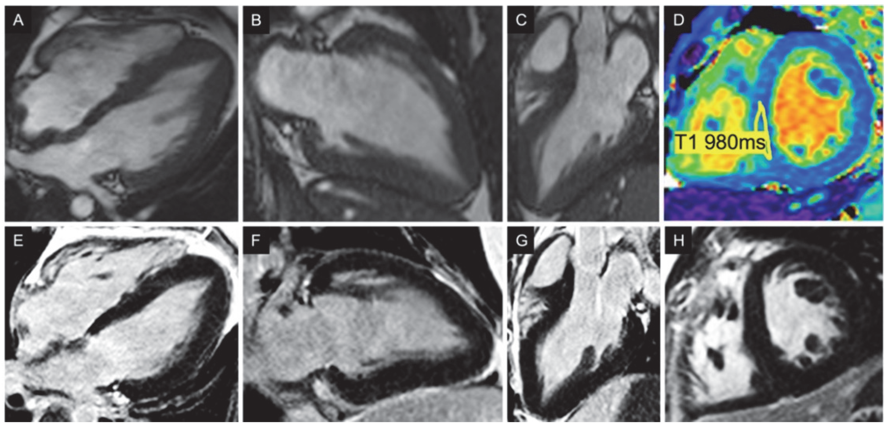 Intrafamilial Phenotypical Variability Linked to PRKAG2 Mutation—Family ...