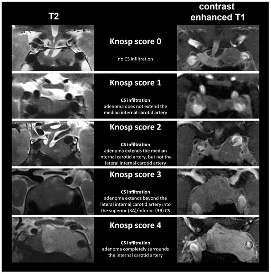 Improved Detection of Cavernous Sinus Invasion of Pituitary ...