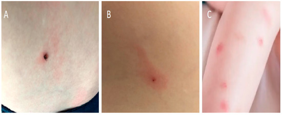 Life | Free Full-Text | Cutaneous Manifestations of Lyme Borreliosis in ...