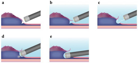 Updates in the Field of Submucosal Endoscopy