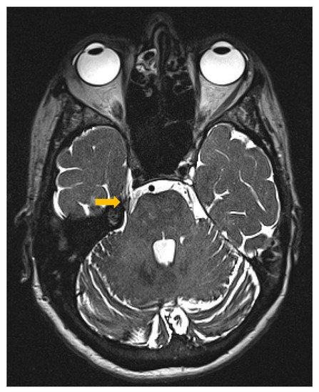 Twenty-Three Months Repetitive Transcranial Magnetic Stimulation of the ...