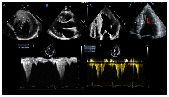 Multimodality Imaging in Sarcomeric Hypertrophic Cardiomyopathy: Get It ...