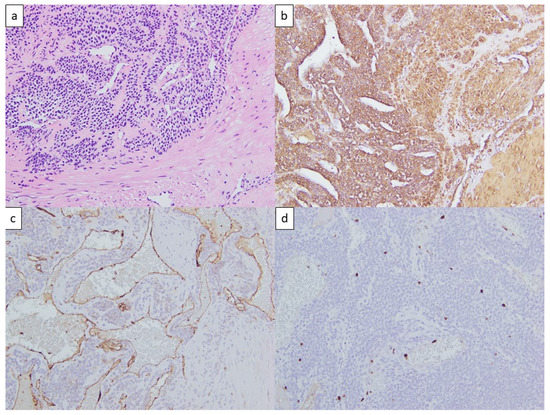 A Rare Gastric Subepithelial Lesion Removed through Submucosal ...