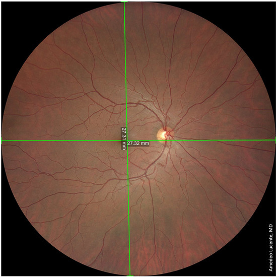 Widefield and Ultra-Widefield Retinal Imaging: A Geometrical Analysis