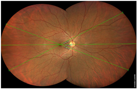 Widefield and Ultra-Widefield Retinal Imaging: A Geometrical Analysis