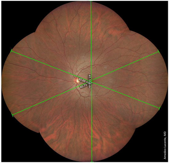 Widefield and Ultra-Widefield Retinal Imaging: A Geometrical Analysis