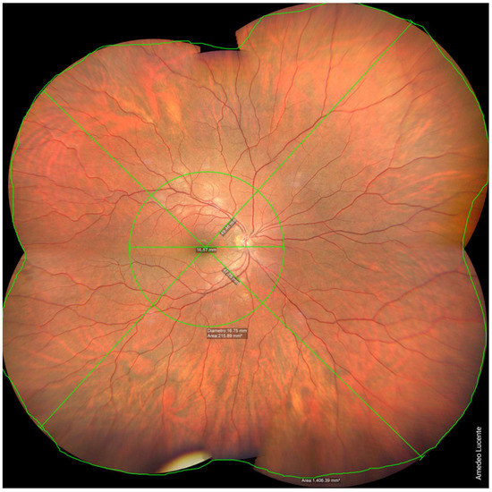 Widefield and Ultra-Widefield Retinal Imaging: A Geometrical Analysis