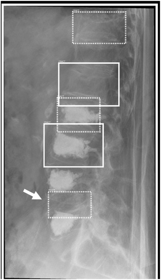 A Prospective Approach to Integration of AI Fracture Detection Software ...