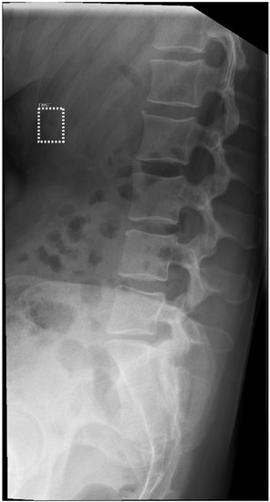 A Prospective Approach to Integration of AI Fracture Detection Software ...