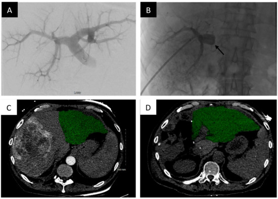 Portal Vein Embolization: Rationale, Techniques, and Outcomes to ...
