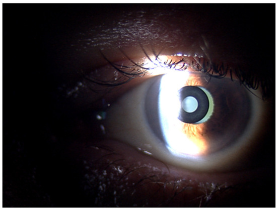 Complications of Small Aperture Intracorneal Inlays: A Literature Review