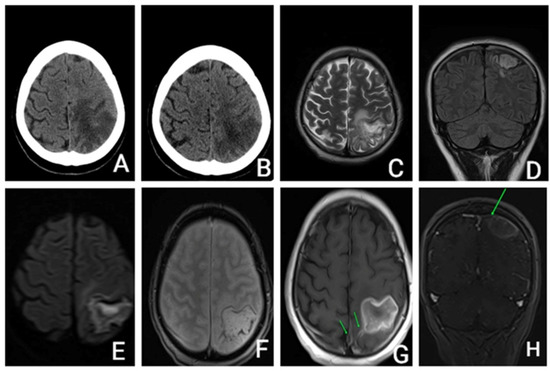 Challenges in Cerebral Venous Thrombosis Management—Case Reports and ...