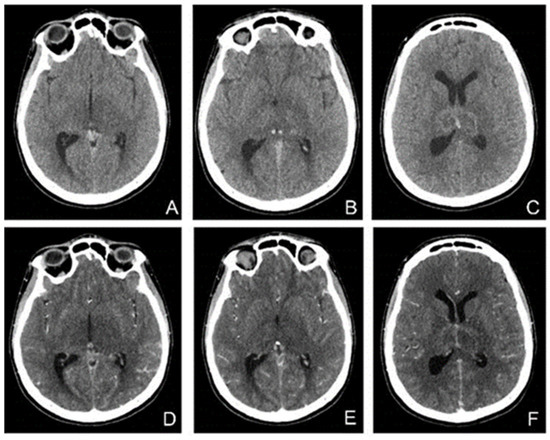 Challenges in Cerebral Venous Thrombosis Management—Case Reports and ...