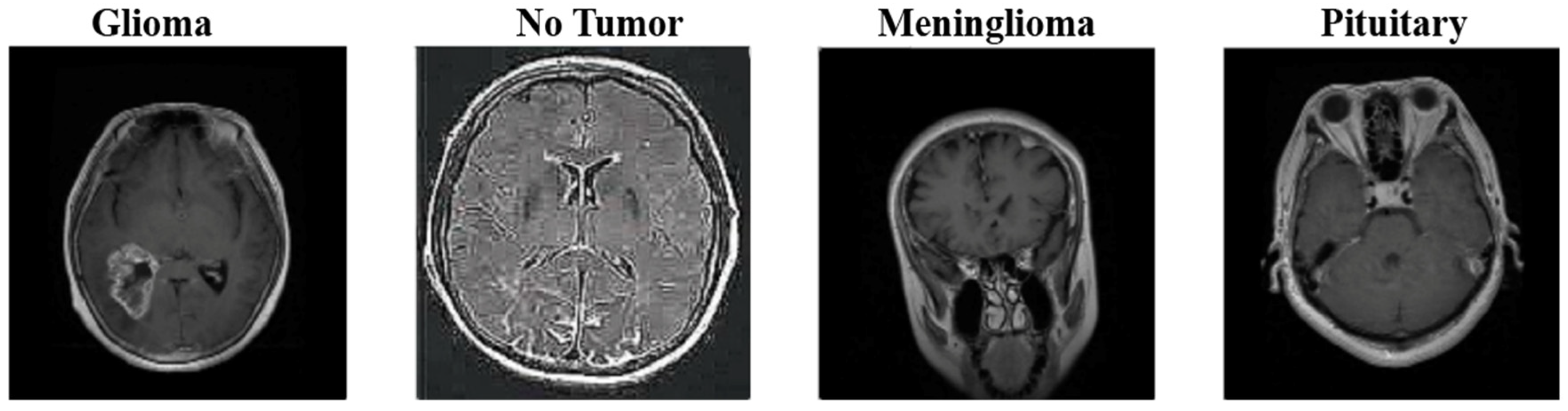 Pdf Enhanced Brain Tumor Detection And Classification In Mri Scans