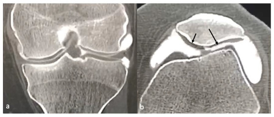 Imaging of Cartilage and Chondral Defects: An Overview