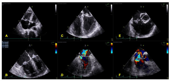 Current Views on Infective Endocarditis: Changing Epidemiology ...