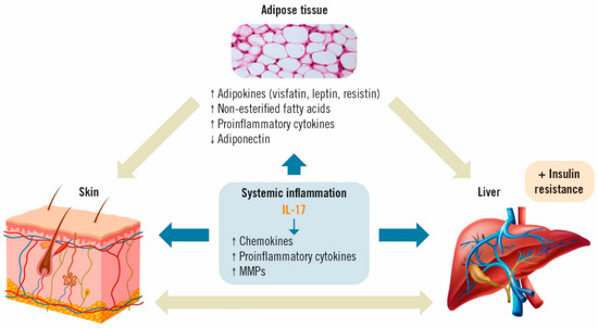 The Essential Role of IL-17 as the Pathogenetic Link between Psoriasis and Metabolic-Associated ...