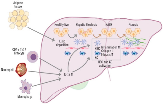 The Essential Role of IL-17 as the Pathogenetic Link between Psoriasis ...