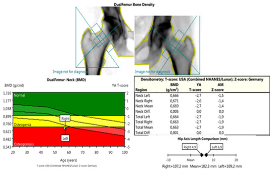 Correlation between Bone Mineral Density and Progression of Hip ...