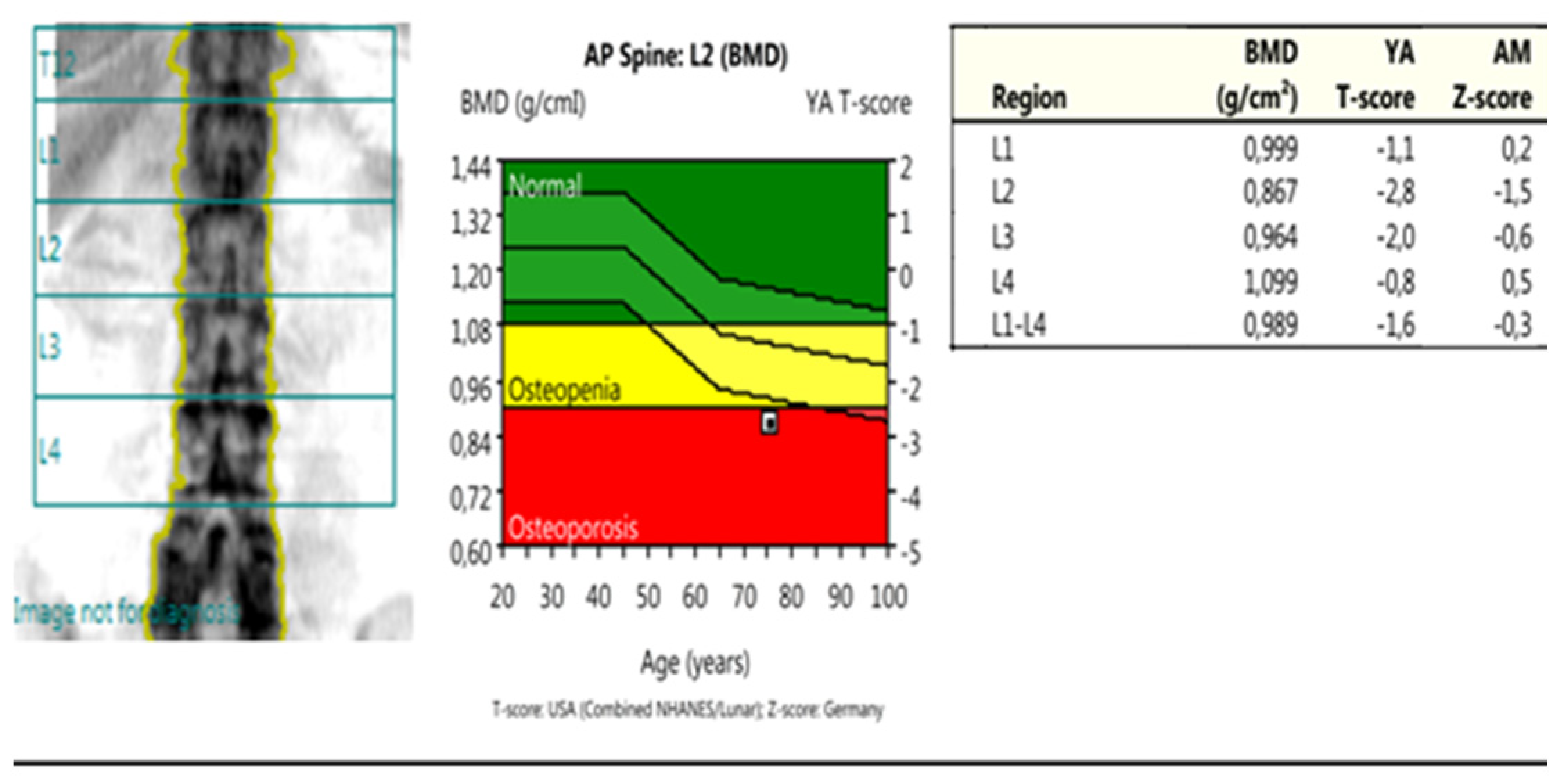 Correlation between Bone Mineral Density and Progression of Hip Osteoarthritis in Adult Men and ...