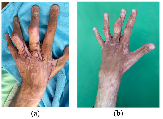 The Efficacy of Wide-Awake Local Anesthesia No Tourniquet (WALANT) in ...