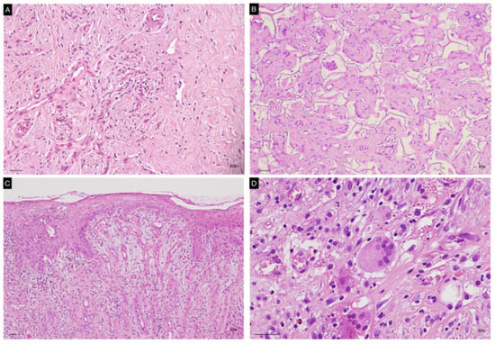 Wound Healing after Acellular Dermal Substitute Positioning in Dermato ...