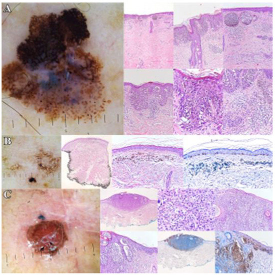 The Many Roles of Dermoscopy in Melanoma Detection