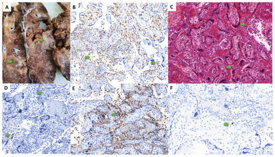 The Histopathological “Placentitis Triad” Is Specific for SARS-CoV-2 ...