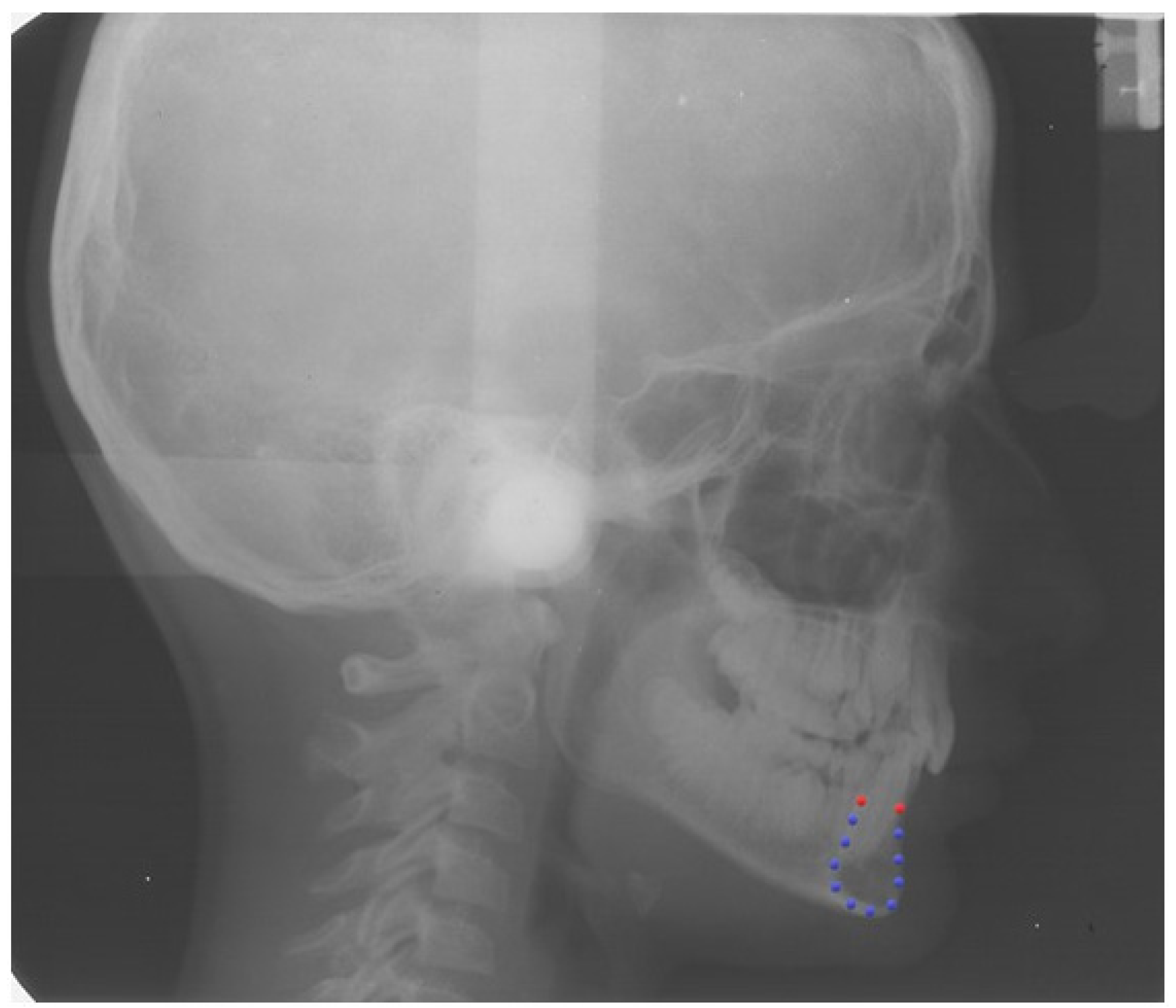 Geometric Morphometric Analysis of Mandibular Symphysis Growth between ...