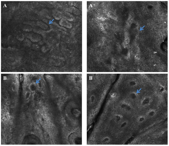 Evaluation of Morphological and Structural Skin Alterations on Diabetic ...