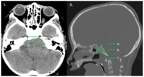 Positioning Transclival Tumor-Treating Fields for the Treatment of ...