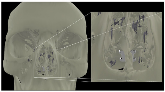 Positioning Transclival Tumor-Treating Fields for the Treatment of ...