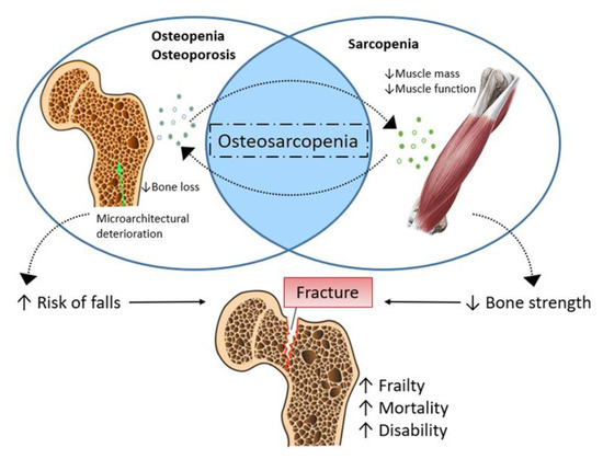 Sharing Circulating Micro-RNAs between Osteoporosis and Sarcopenia: A Systematic Review