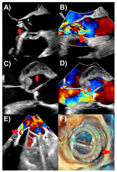 Contemporary Review of Multi-Modality Cardiac Imaging Evaluation of ...