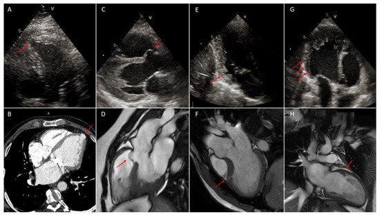 The Use of Multimodality Imaging for the Diagnosis of Myocardial ...