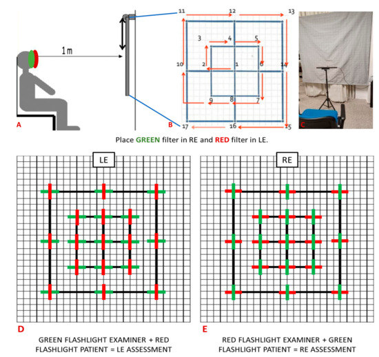 Life | Free Full-Text | Hess Lancaster Screen Test with Eye Tracker: An ...