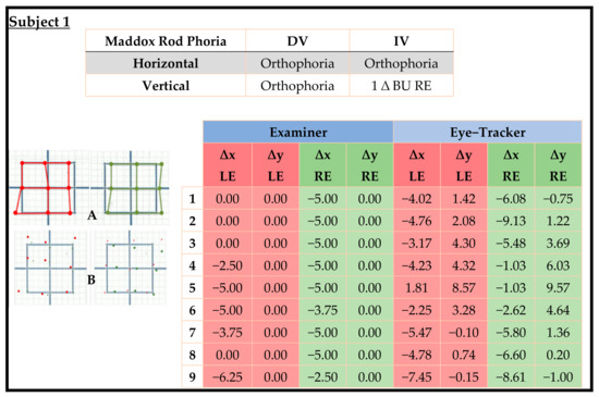 Hess Lancaster Screen Test with Eye Tracker: An Objective Method for ...