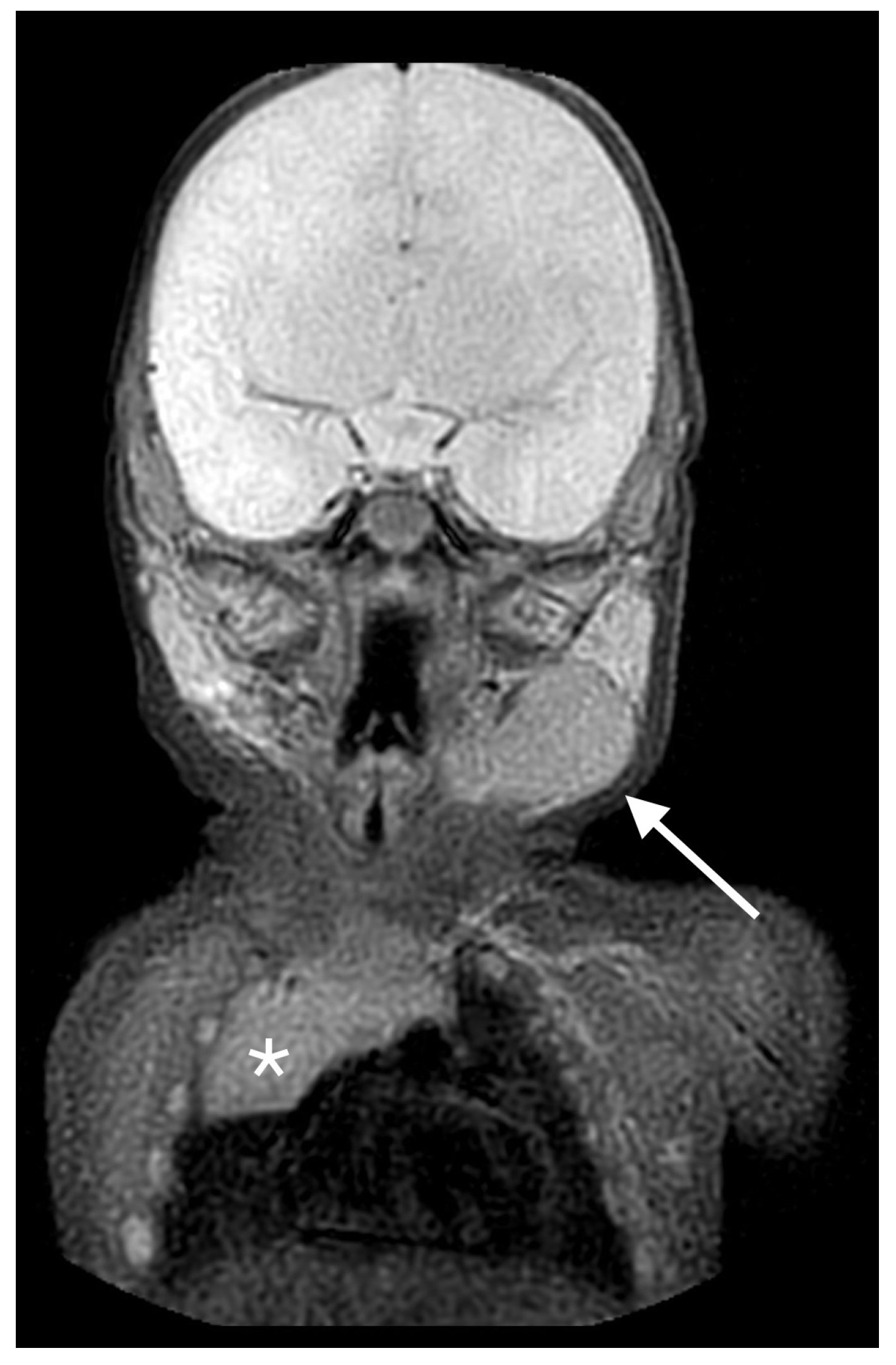 Thymic Petechiae at Mina Clemmer blog