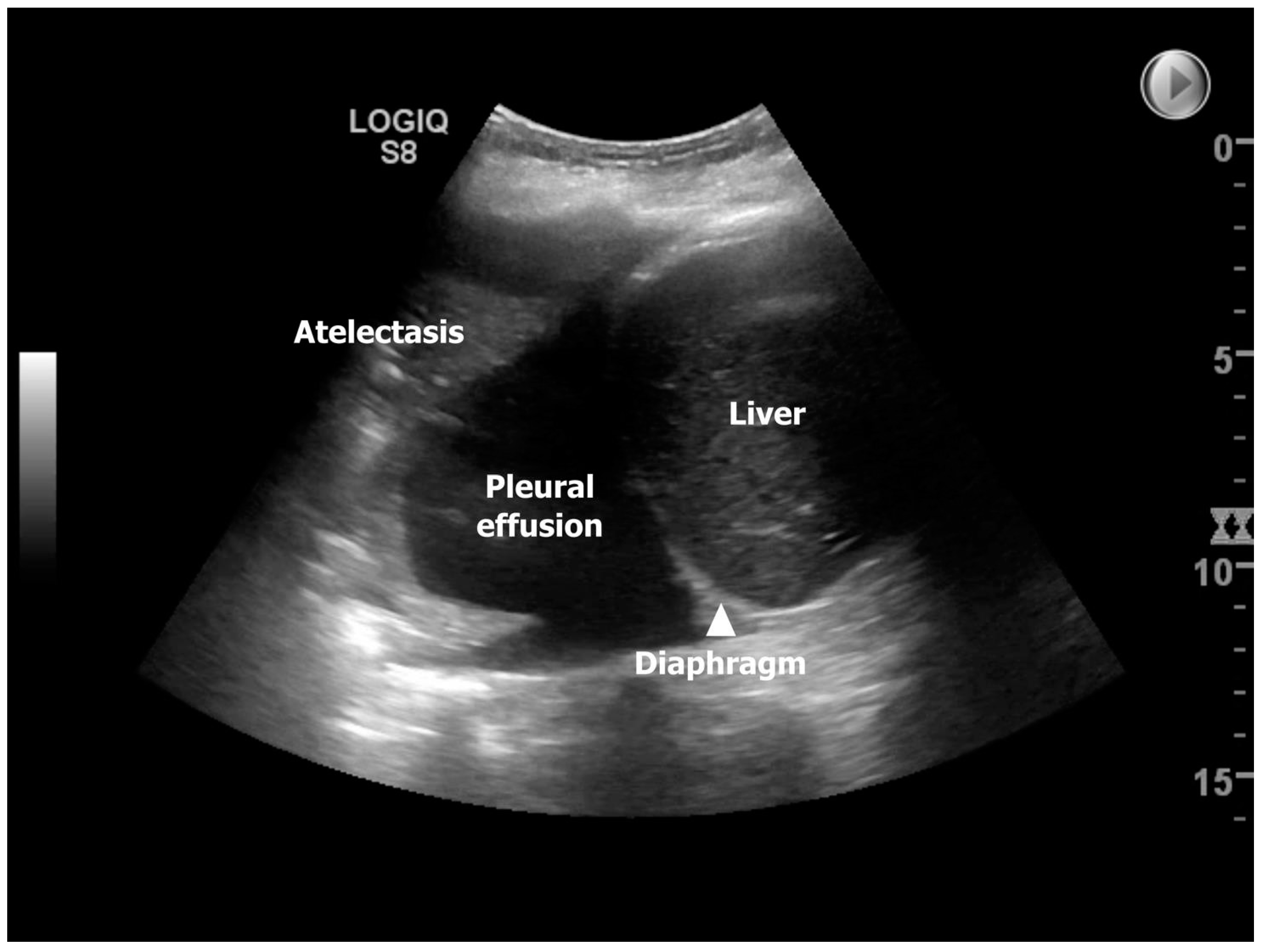 Pleural Effusion Ultrasound