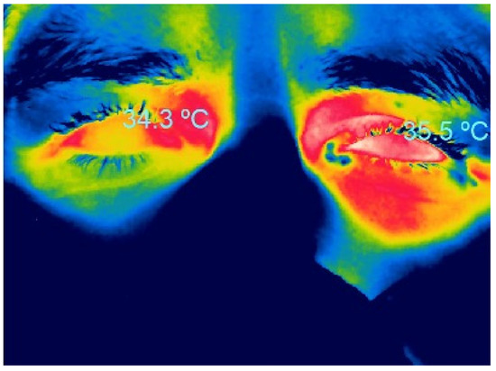 Applications of Infrared Thermography in Ophthalmology