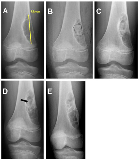 Bovine Grafting: An Effective Alternative after Curettage of Benign ...