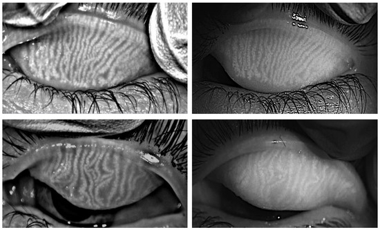 A Comparative Study of Two Imaging Techniques of Meibomian Glands