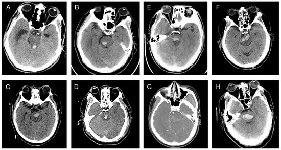 ZJUSAH Classification: A New Classification for Primary Brainstem Hemorrhage