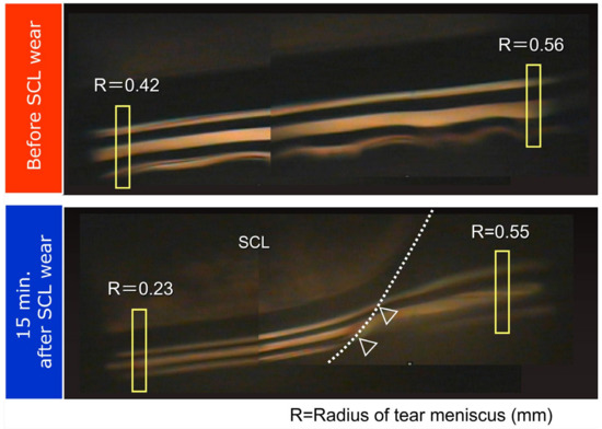 Dynamic Aspects of Pre-Soft Contact Lens Tear Film and Their Relation ...