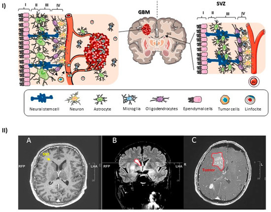 Neural Stem Cells as Potential Glioblastoma Cells of Origin