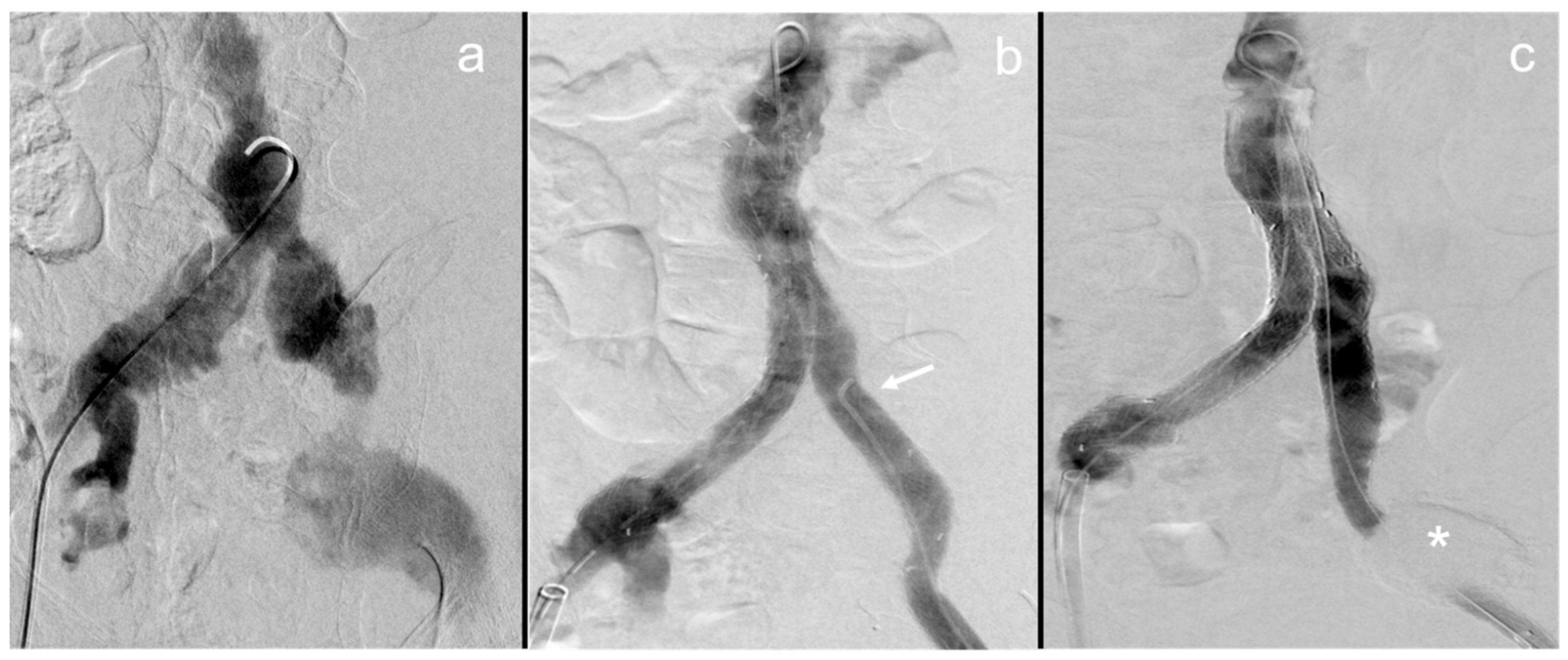 Life Free Full Text Endovascular Aneurysm Sac Embolization For