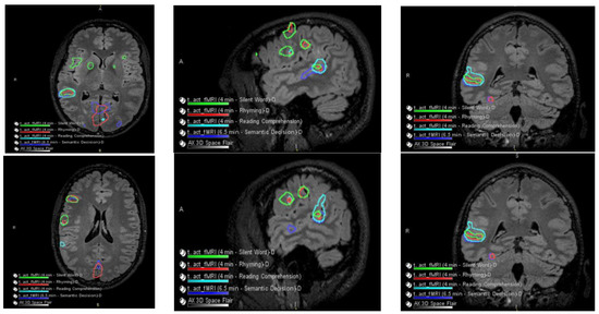 Life | Free Full-Text | The Possibility of Eidetic Memory in a Patient ...