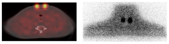 A Neck-Thyroid Phantom with Small Sizes of Thyroid Remnants for ...