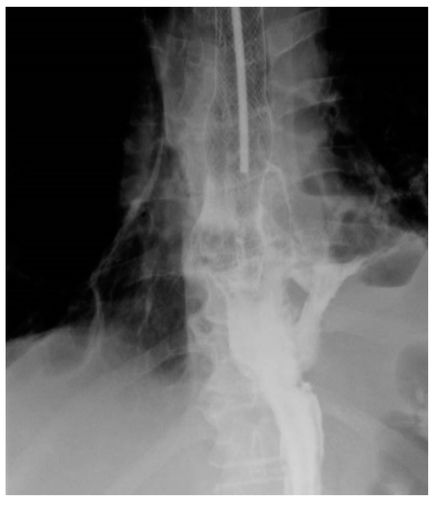 The Use of Esophageal Stents in the Management of Postoperative ...