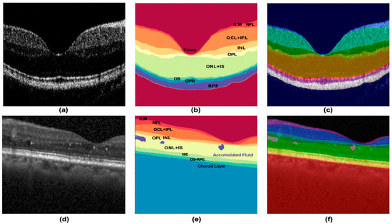 TranSegNet: Hybrid CNN-Vision Transformers Encoder for Retina ...